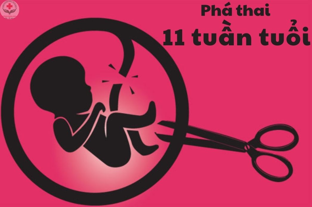 Phá thai 11 tuần tuổi bằng phương pháp nào hiệu quả - Phòng Khám Đa ...